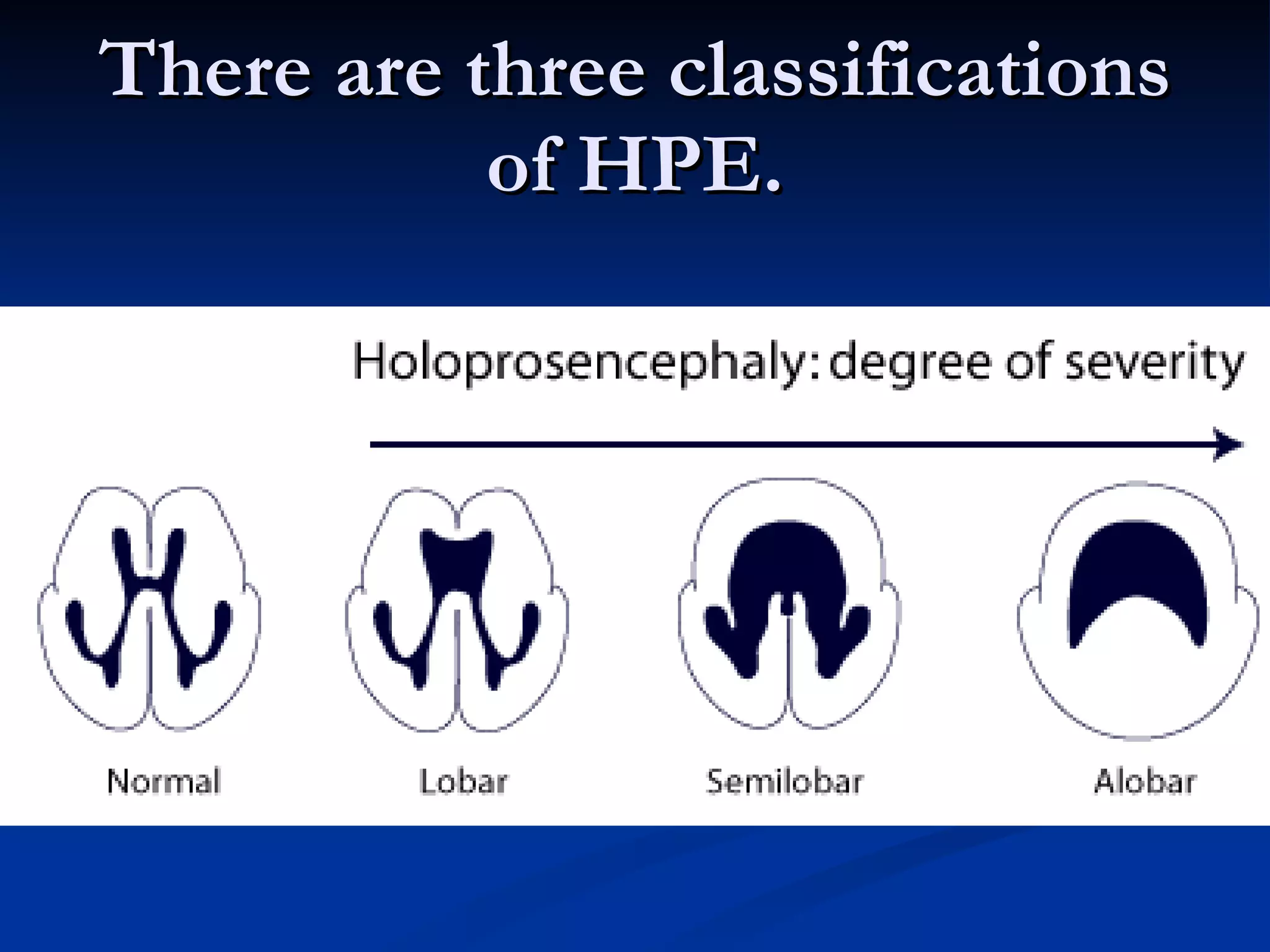 Holoprosencephaly | PPT