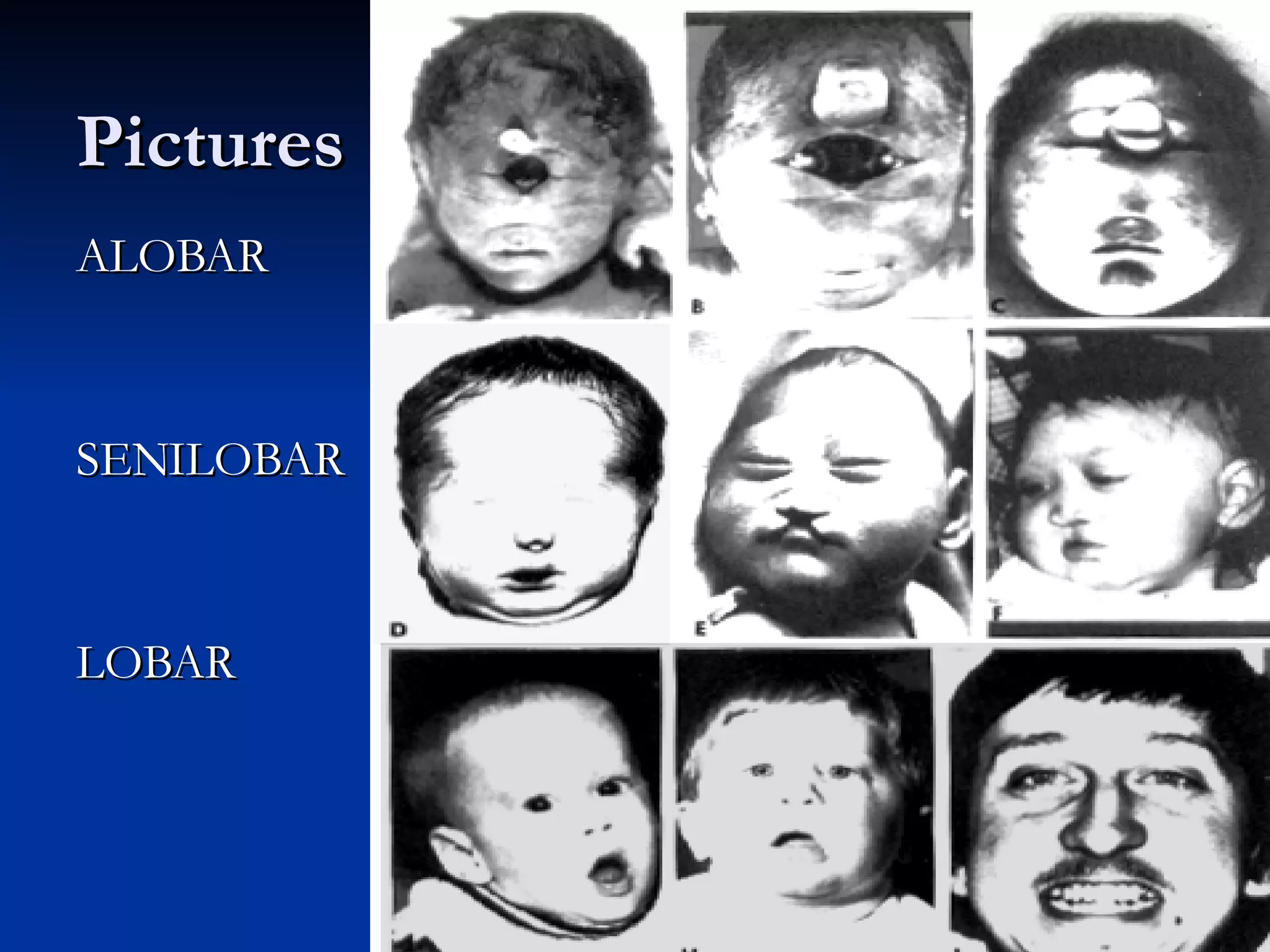 Holoprosencephaly | PPT