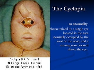 Holoprosencephaly | PPT