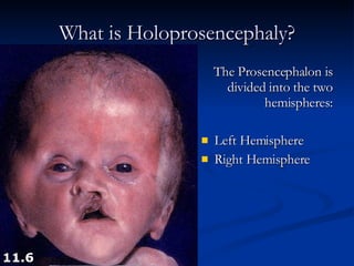Holoprosencephaly | PPT