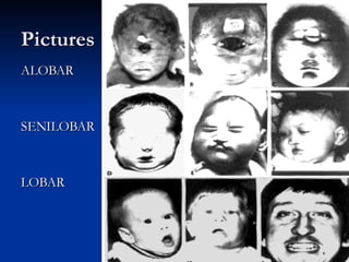 Holoprosencephaly | PPT