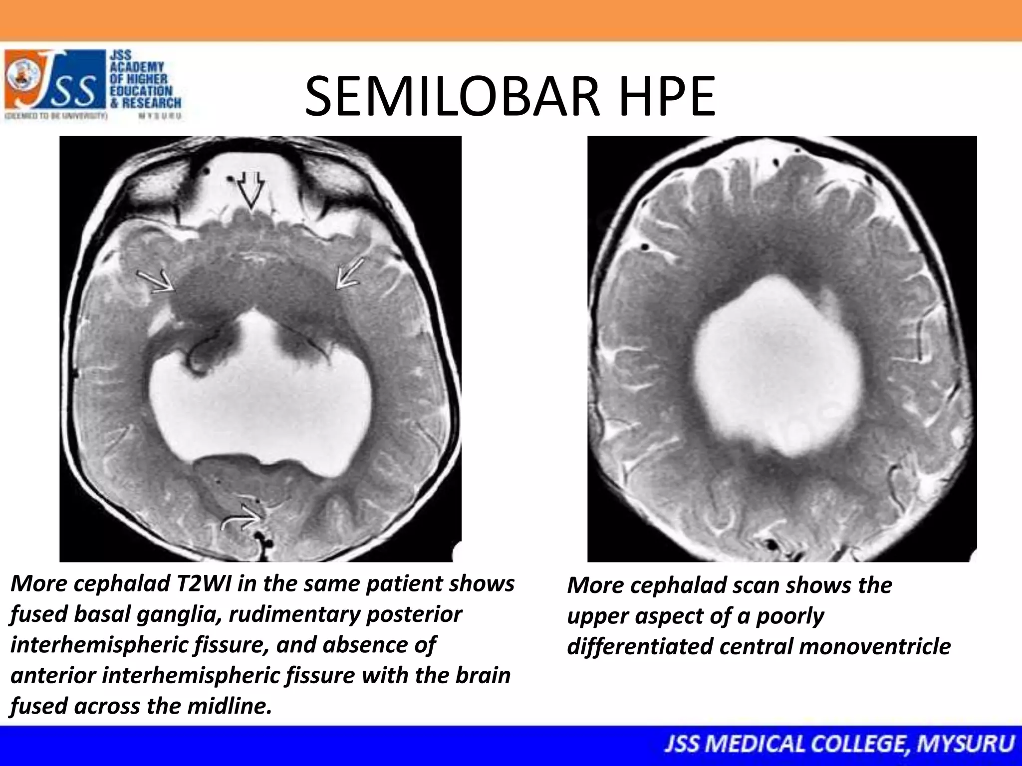 Holoprosencephaly | PPT