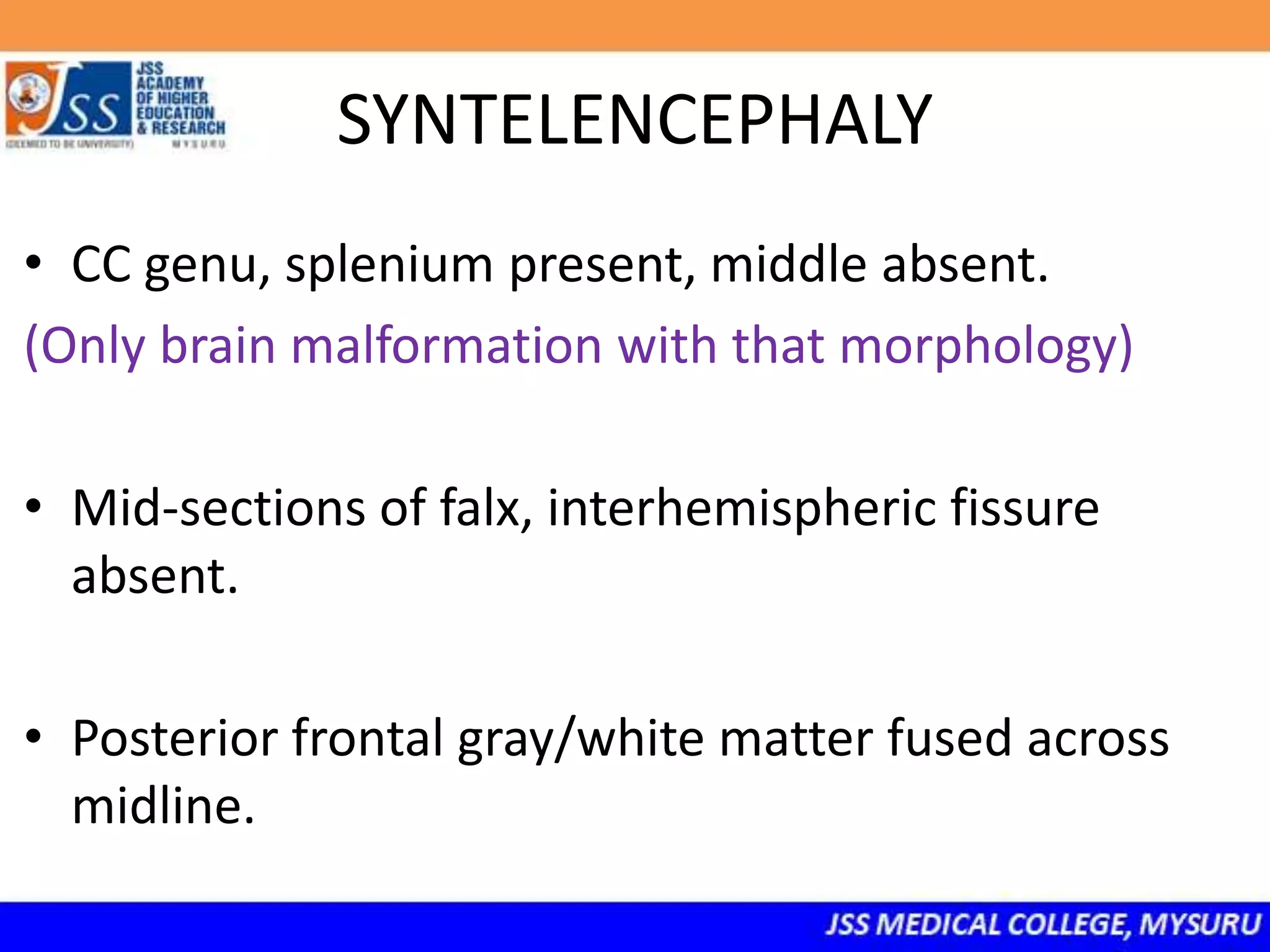 Holoprosencephaly | PPT