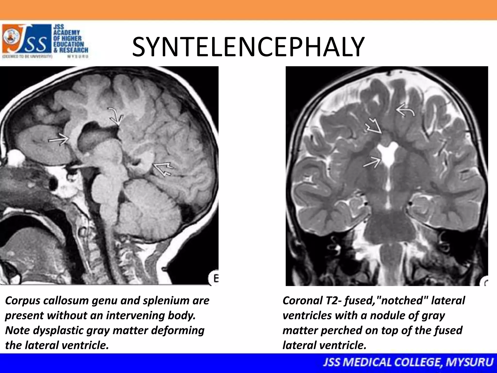 Holoprosencephaly | PPT