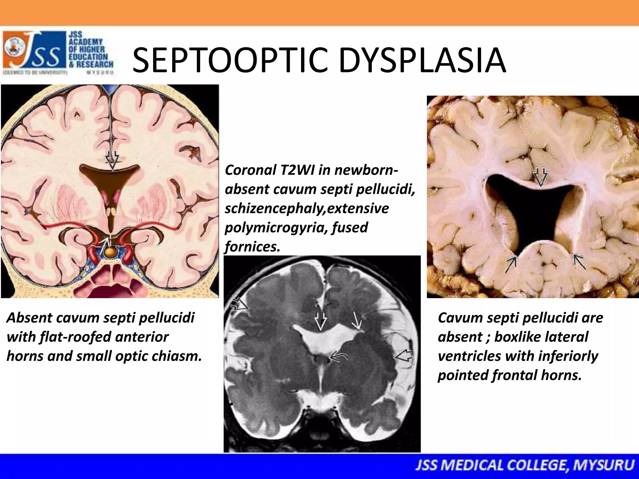 Holoprosencephaly | PPT
