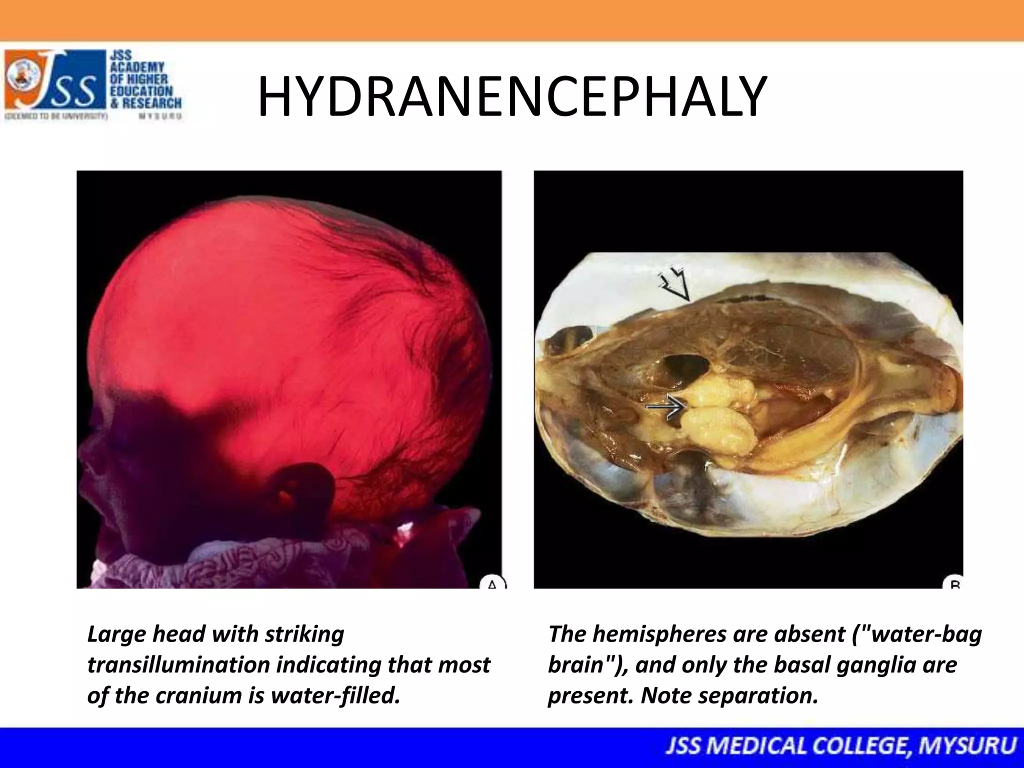 Holoprosencephaly | PPT
