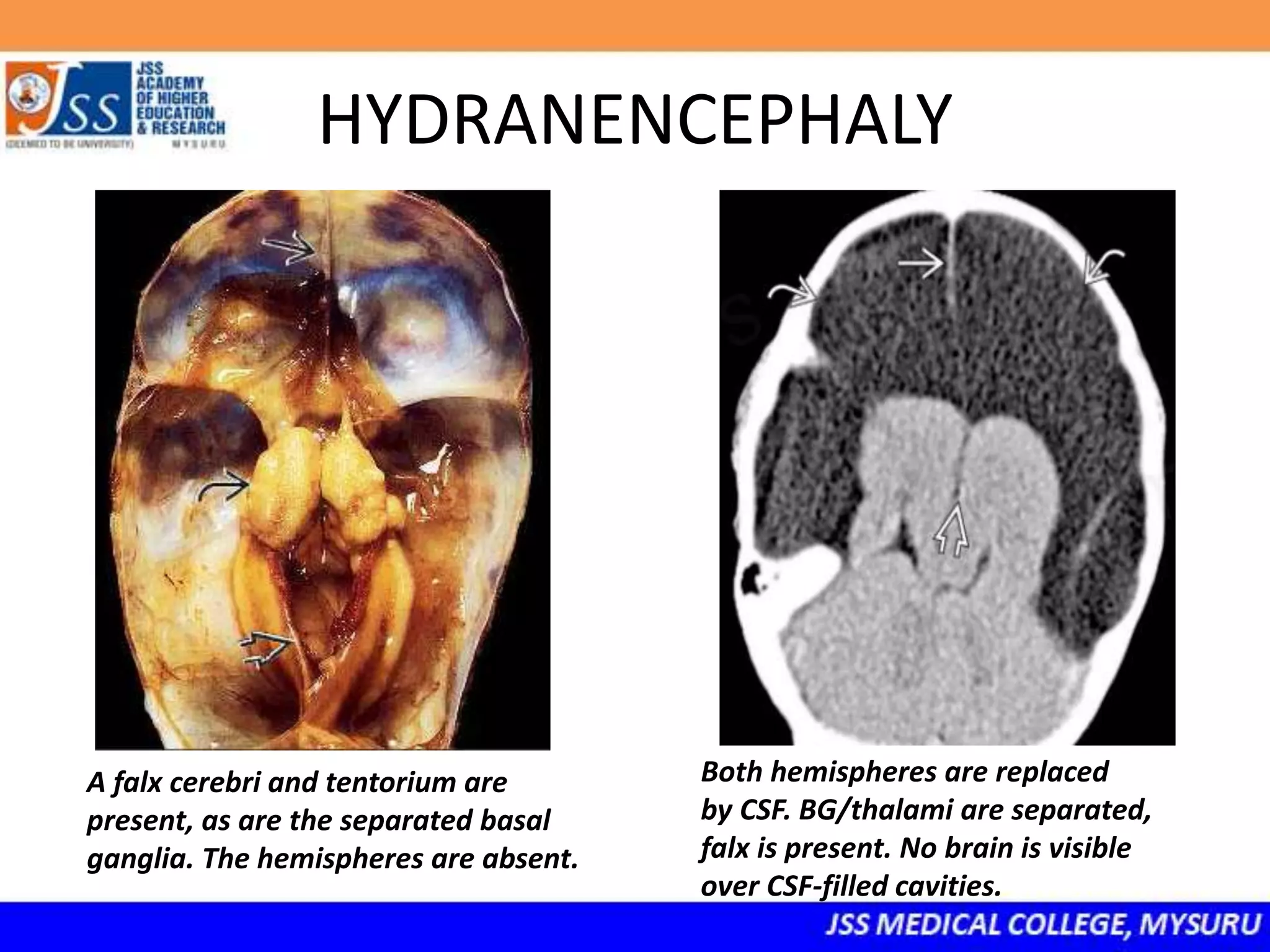 Holoprosencephaly | PPT