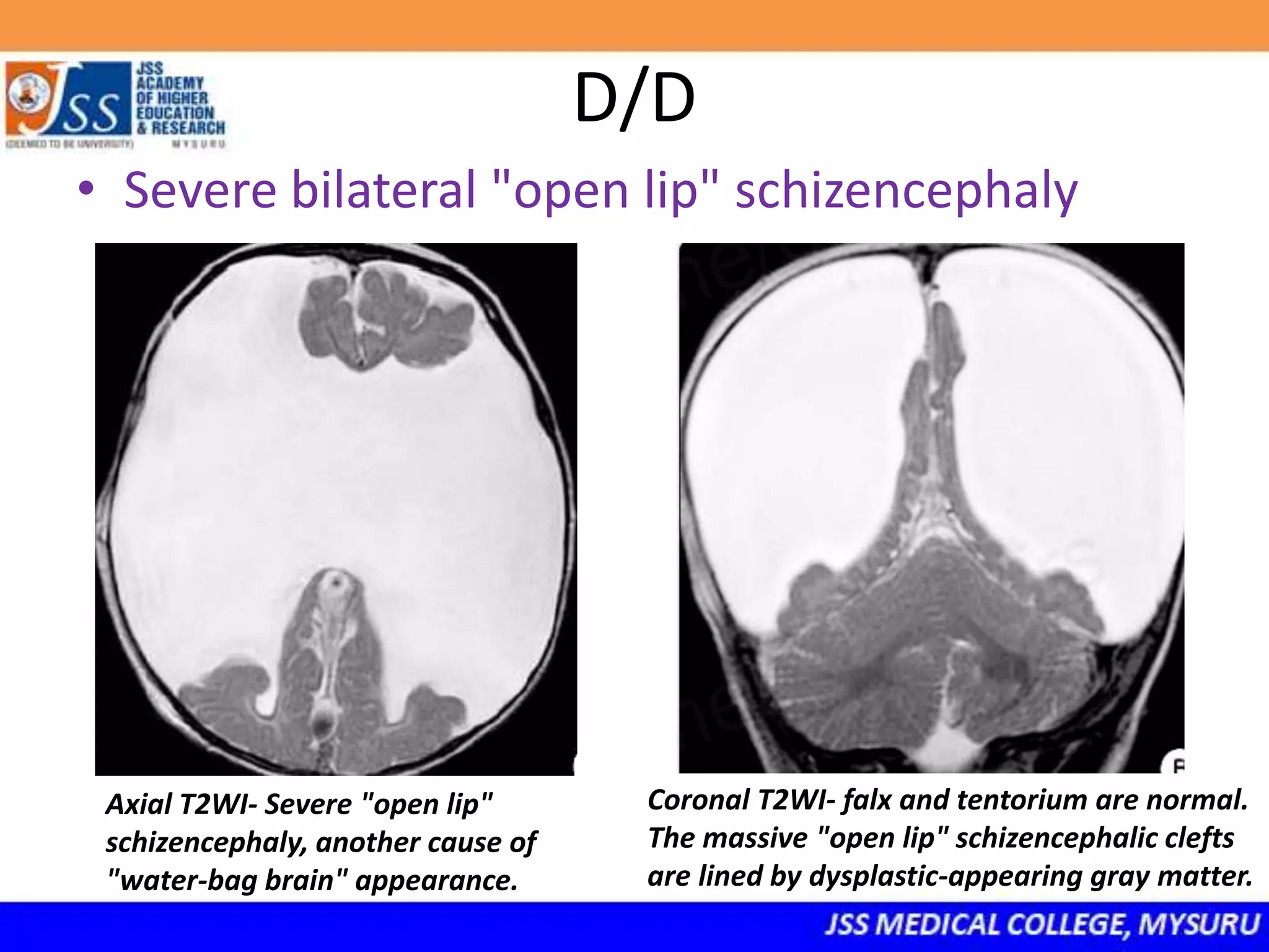 Holoprosencephaly | PPT
