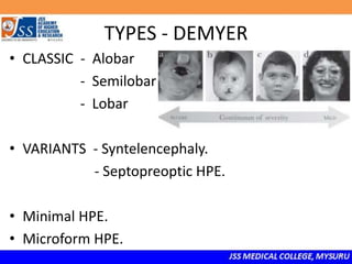 Holoprosencephaly | PPT
