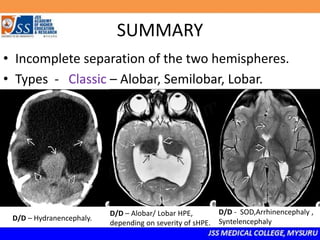 Holoprosencephaly | PPT