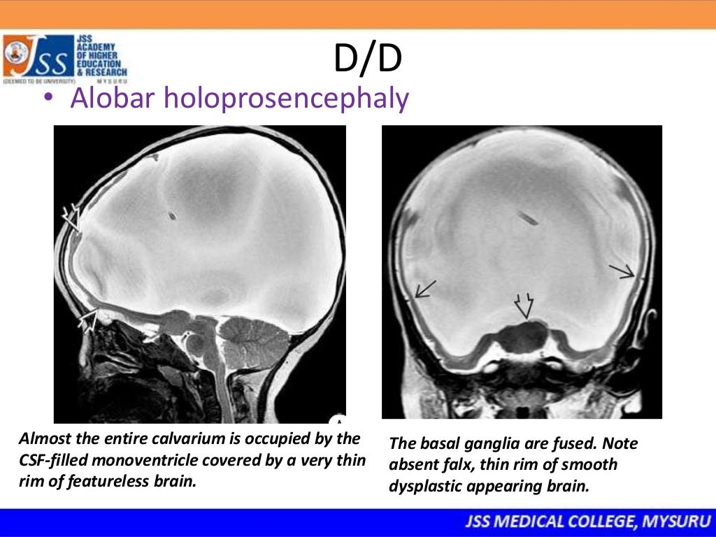 Holoprosencephaly