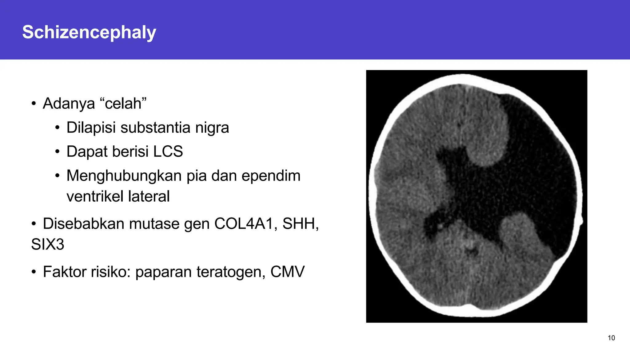 holoprosencephaly definition classification.pptx