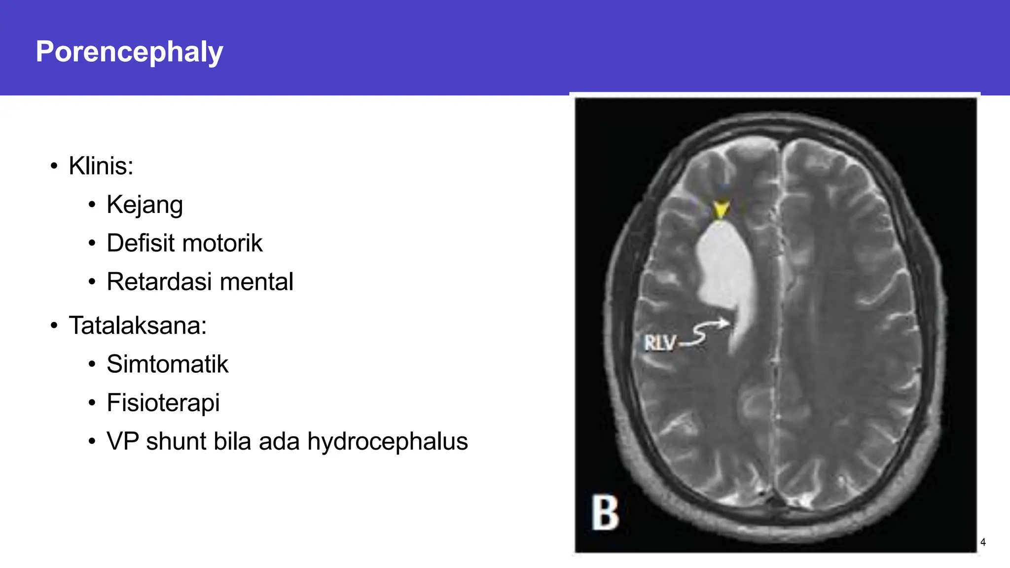 holoprosencephaly definition classification.pptx
