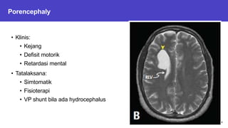 holoprosencephaly definition classification.pptx
