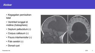 holoprosencephaly definition classification.pptx