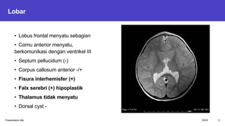 holoprosencephaly definition classification.pptx
