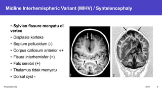 holoprosencephaly definition classification.pptx