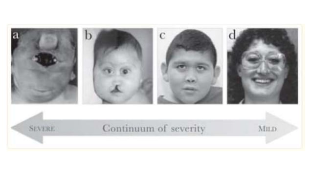 holoprosencephaly definition classification.pptx
