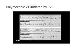 Approach to holter monitoring and it's indication | PPTX