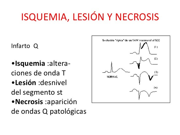 HOLTER, ISQUEMIA, LESION, NECROSIS, y CRECIMIENTO DE CAVIDADES