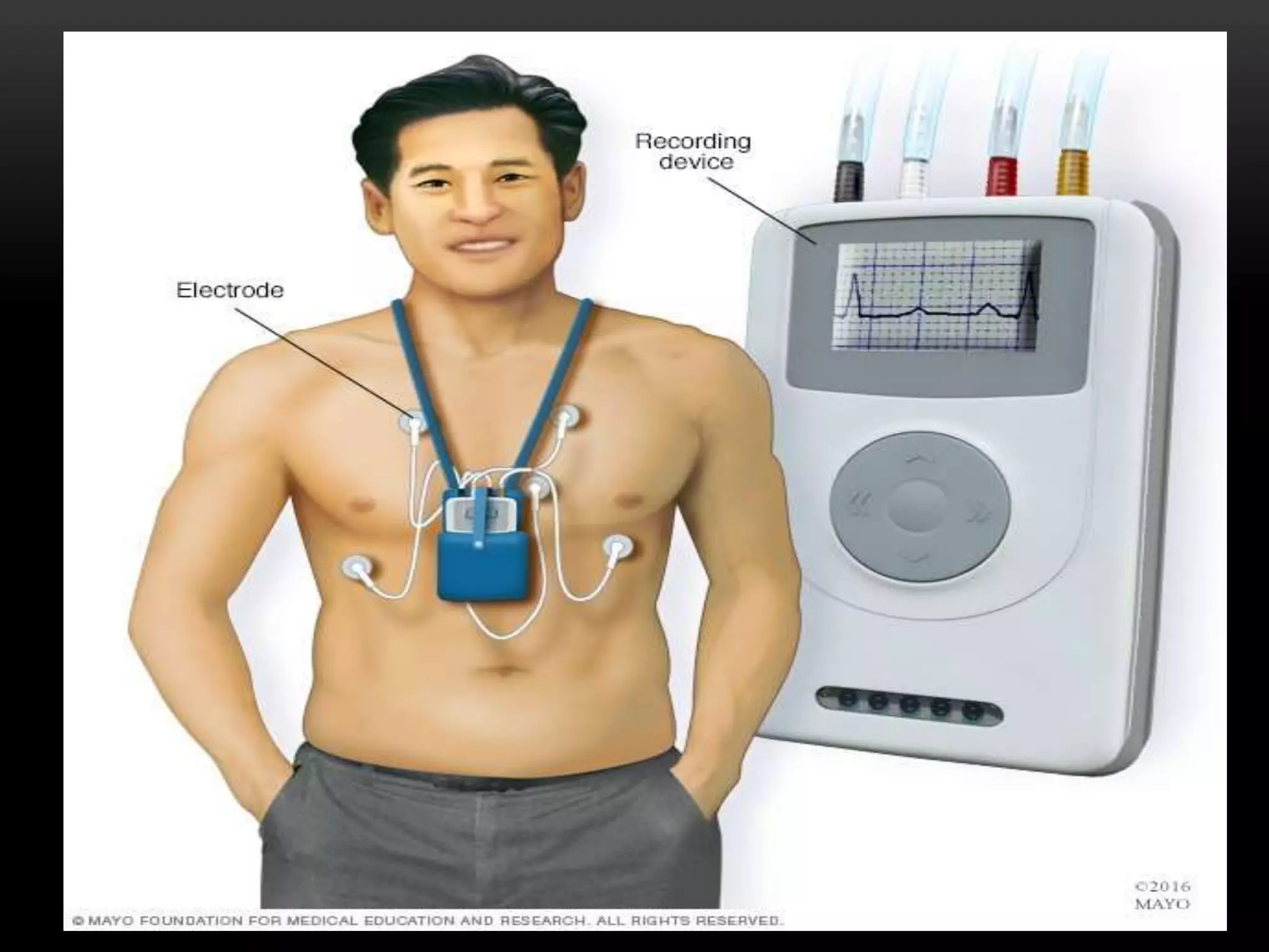 Holter monitoring | PPTX