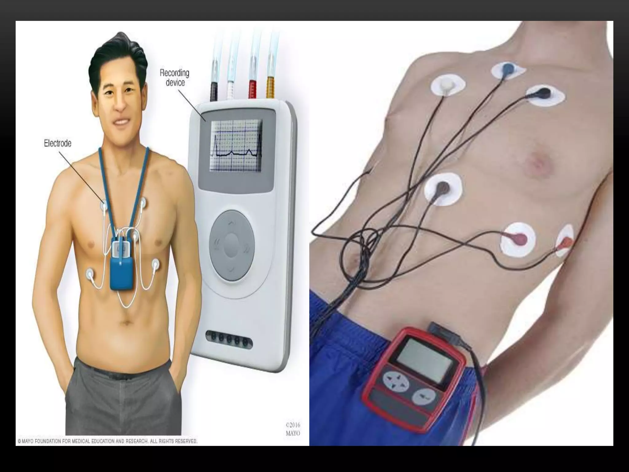 Holter monitoring | PPTX