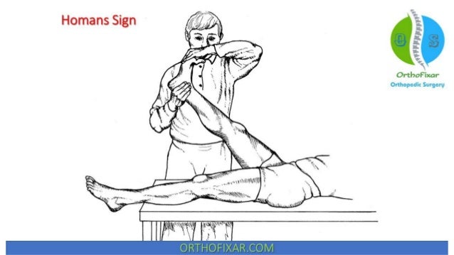 Homan’s Sign for DVT.pptx