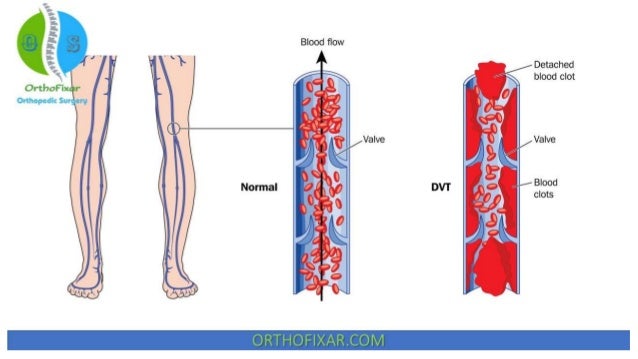 Homan’s Sign for DVT.pptx