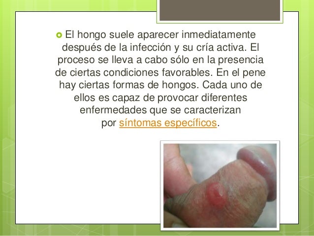 Hombres con infecciones hongos genitales o levaduras posible 3 remedi…