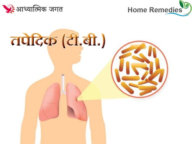 Homemade Remedies for Tuberculosis (TB) - 038 | PPT