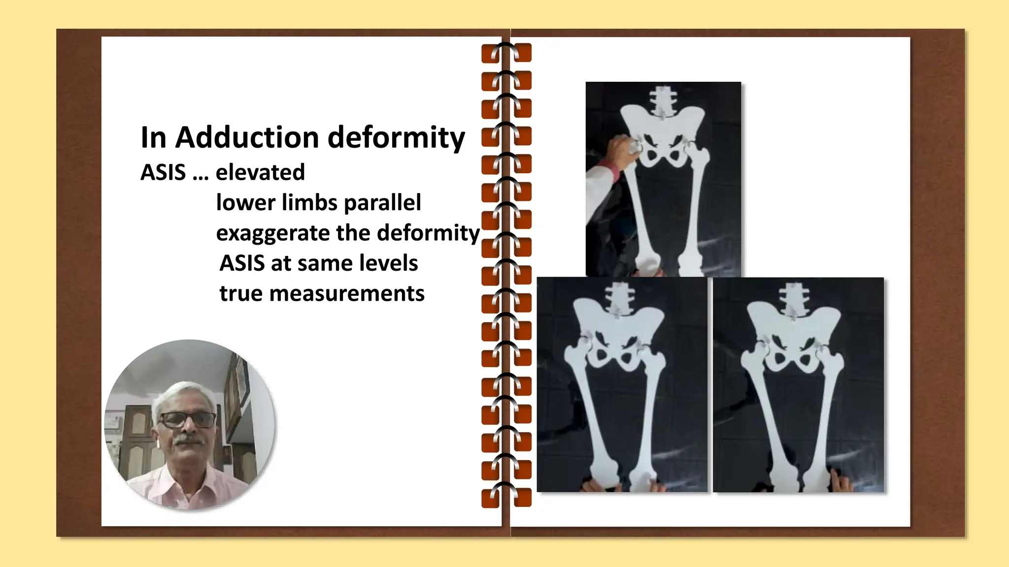 Squaring of the Pelvis in the examination of the Hip case ... HOME ...