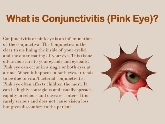 Conjunctivitis- Prevention Tips and Treatments | PPT
