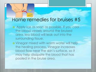 Home Remedies Presentation | PPTX
