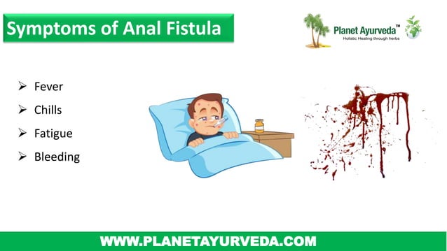 Treatment of Anal Fistula with Home Remedies - Without Surgery | PPTX