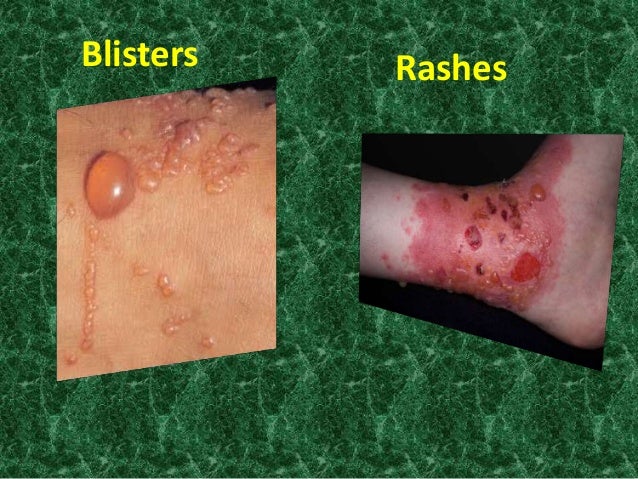 Poison Ivy Blisters