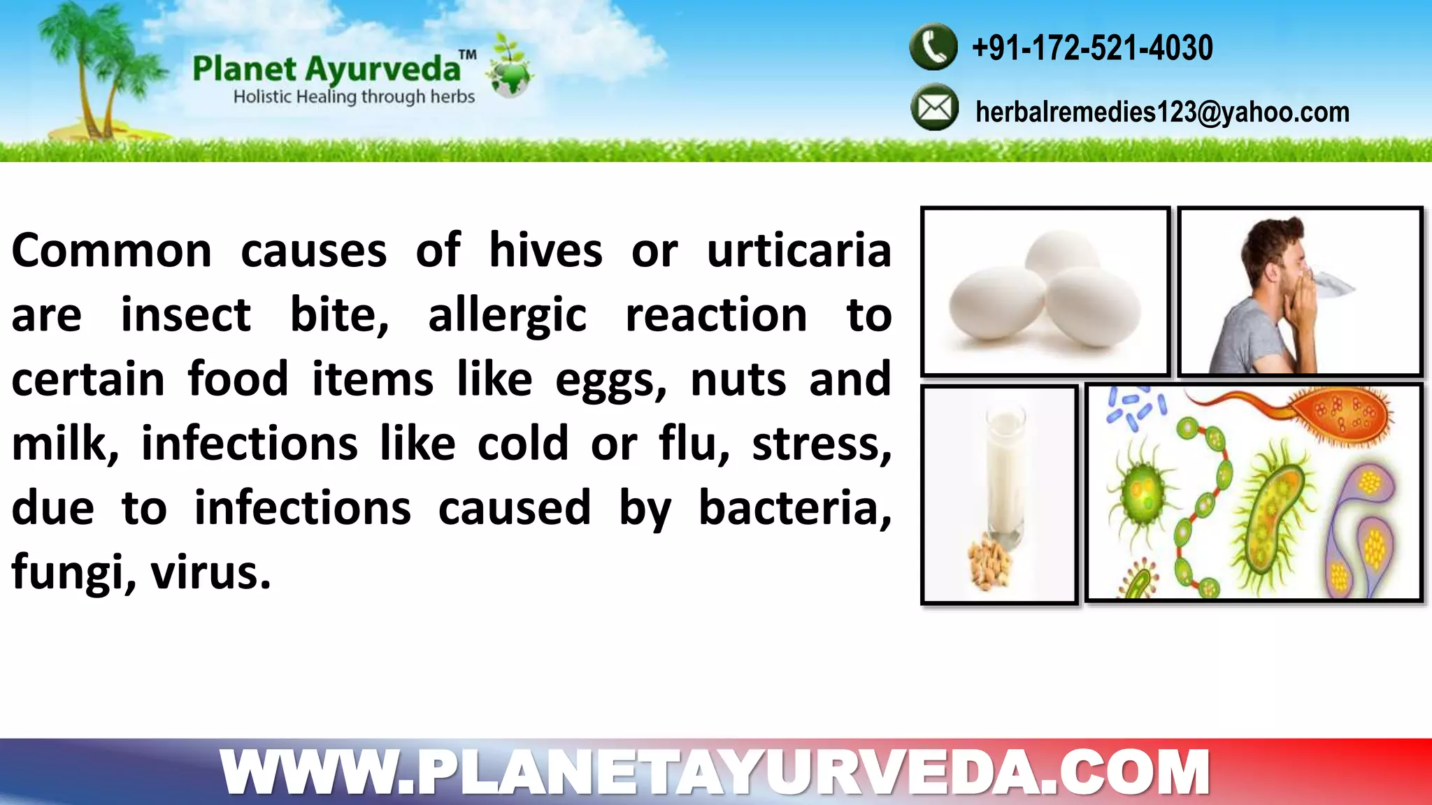 Home Remedies To Get Rid Of Hives or Urticaria | PPTX