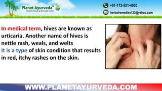 Home Remedies To Get Rid Of Hives or Urticaria | PPTX