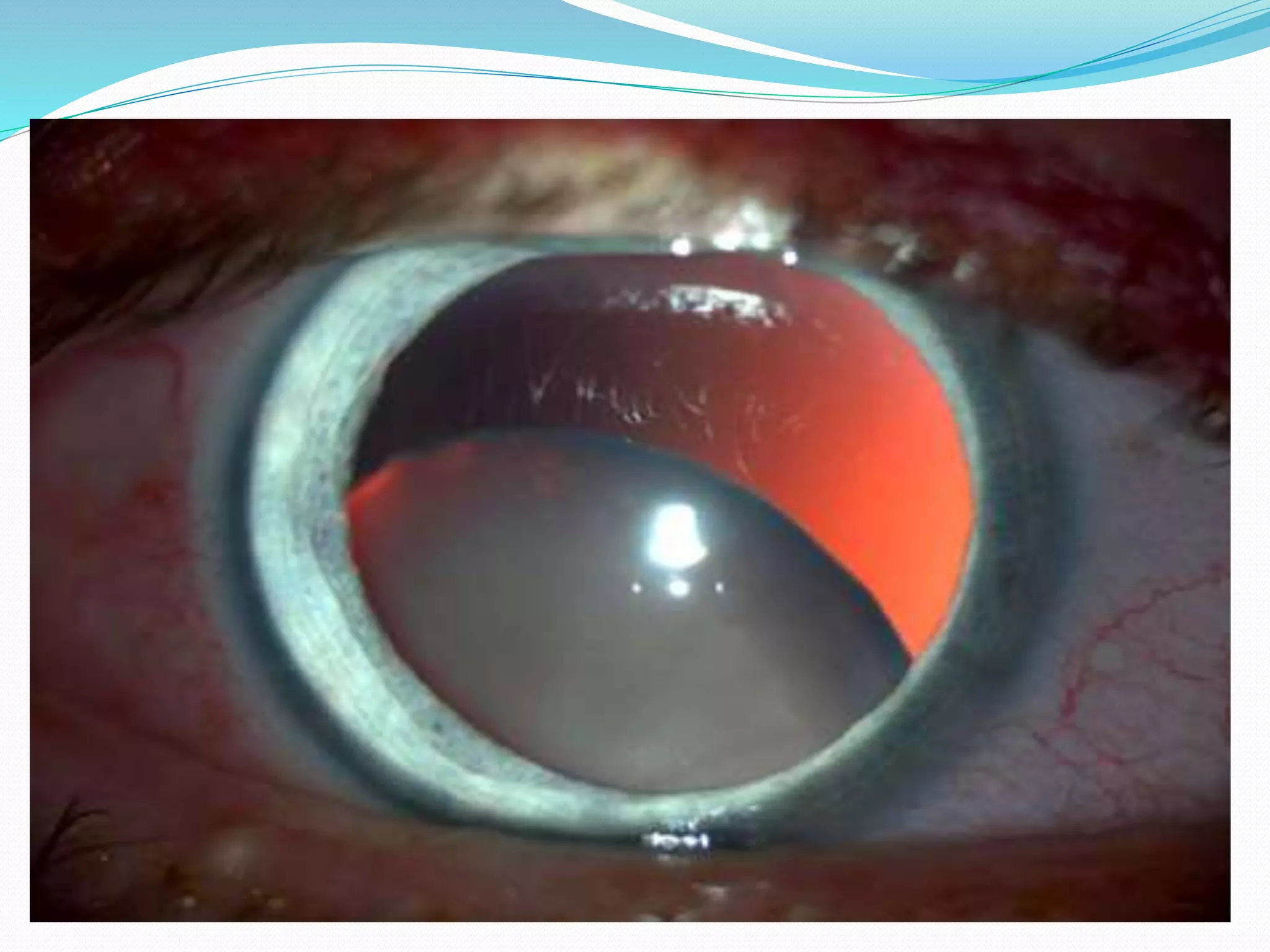 Homocystinuria | PPTX