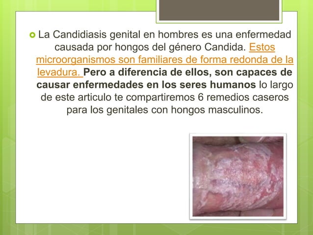 Hongos Genitales Masculinos Tratamiento – Que Causa las Infecciones por ...