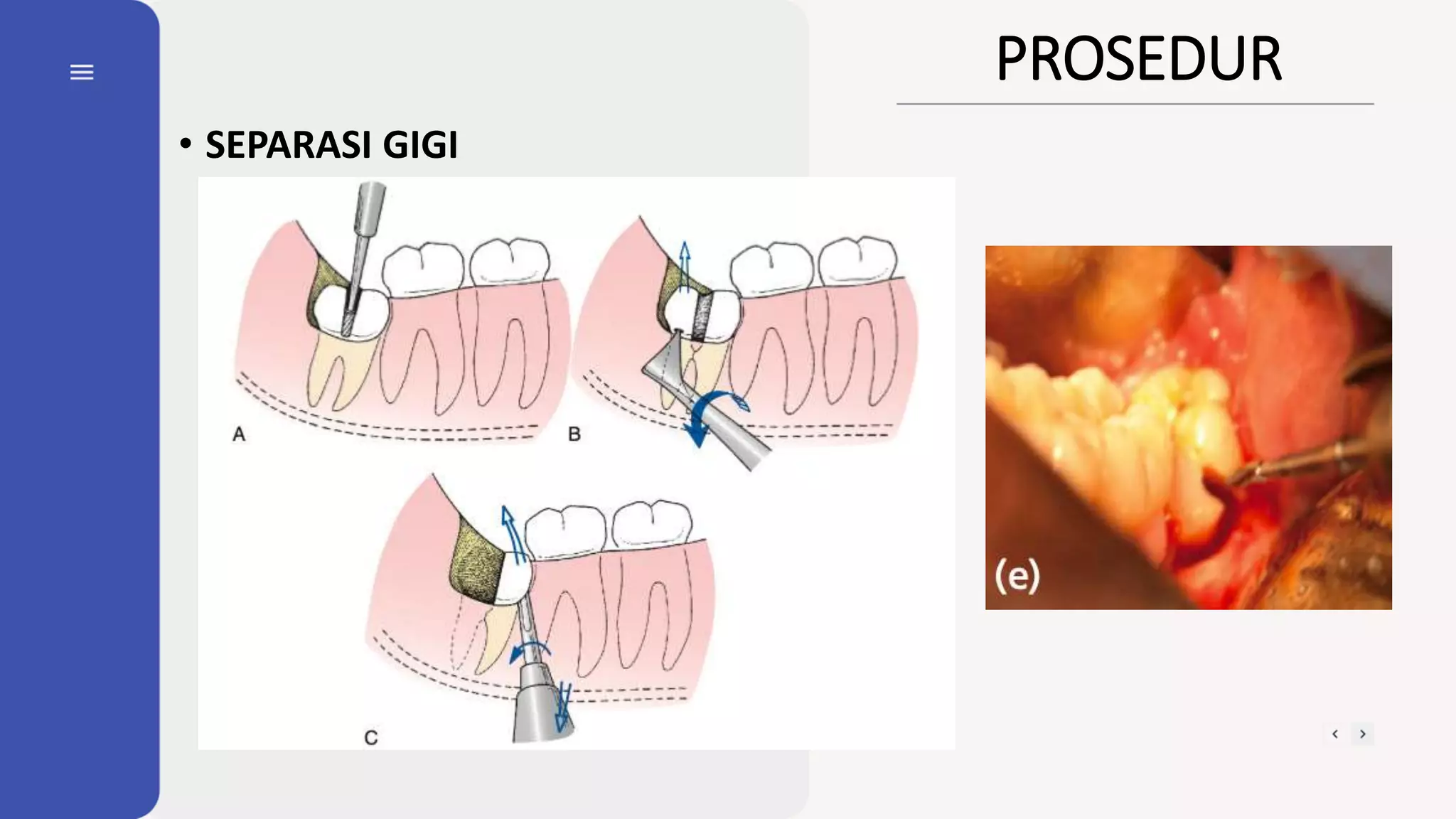 HO Odontektomi-1.pptx