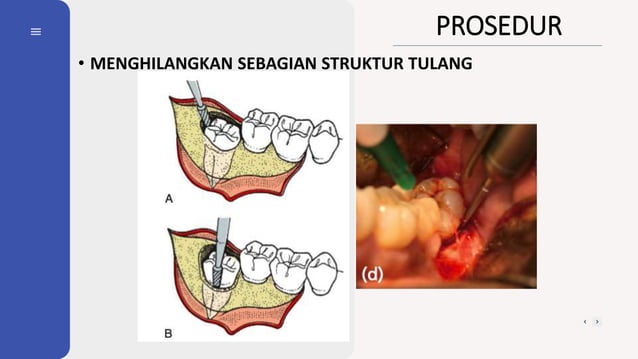 HO Odontektomi-1.pptx