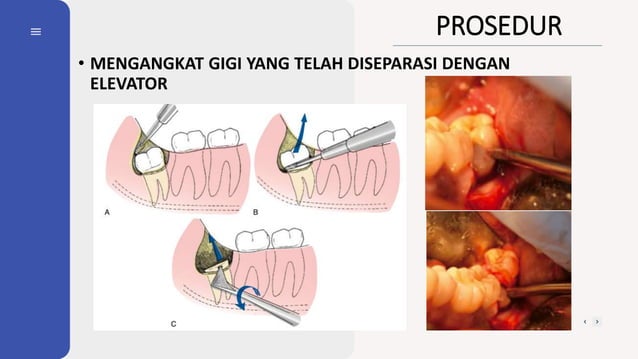 HO Odontektomi-1.pptx
