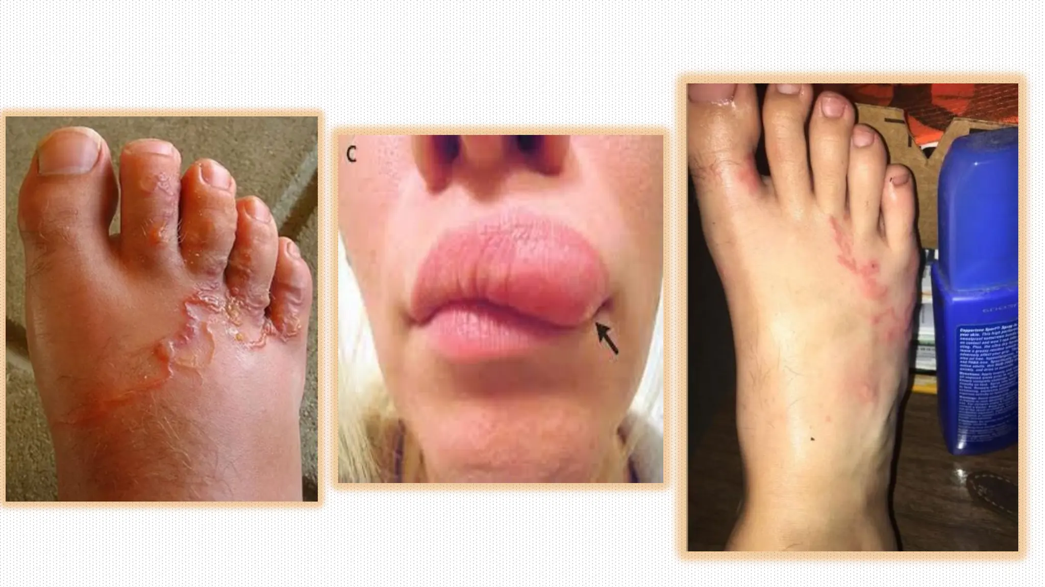 Slide to define about Hookworm infestation | PDF