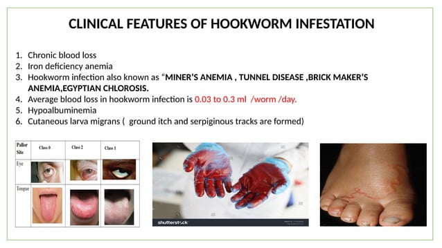 hookworm epidemiology and levels of prevention | PPT