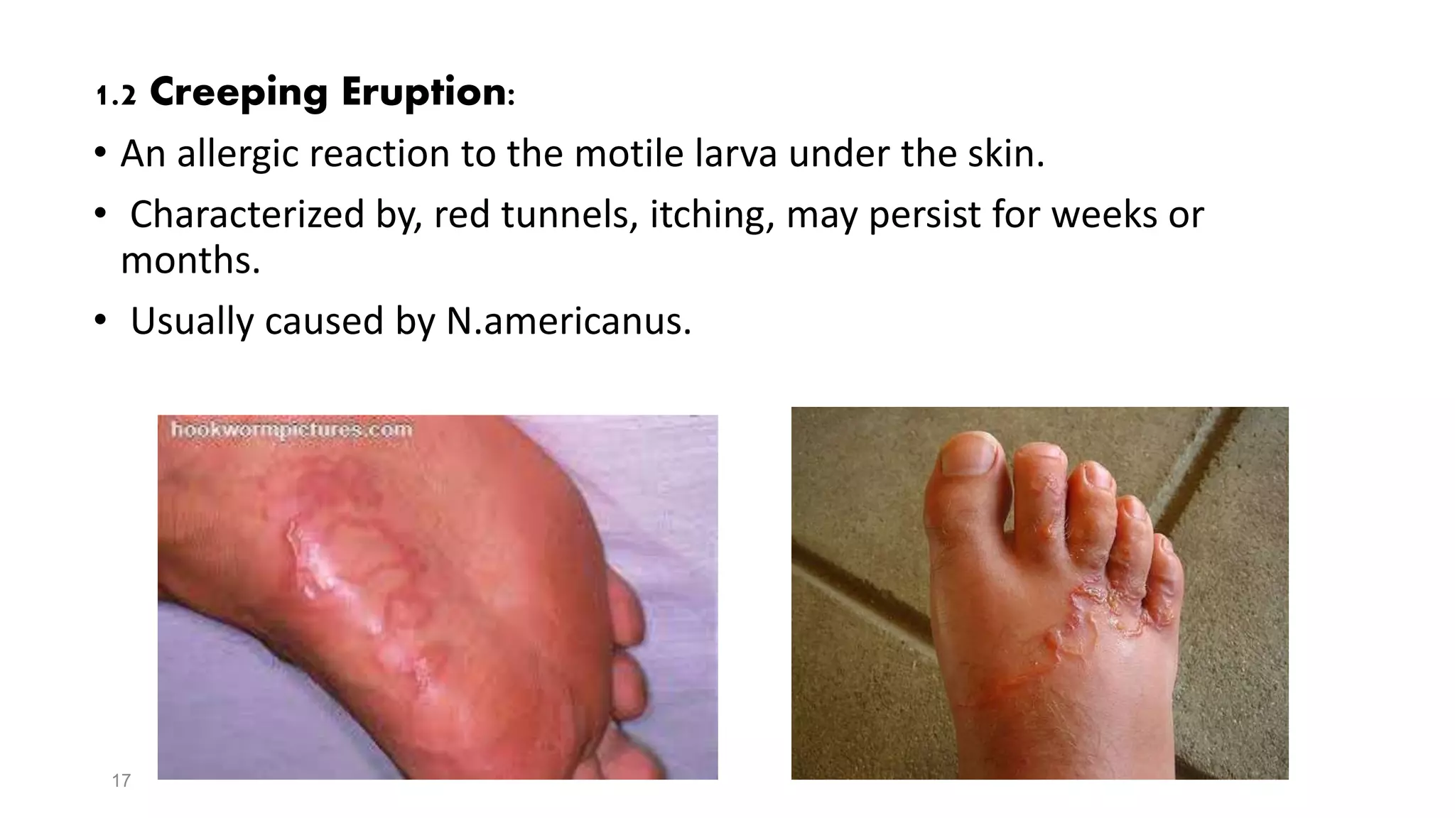 Hookworms | PPTX