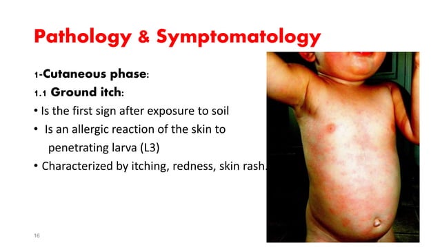 Hookworms Pptx Digestive Disorders Diseases And Conditions