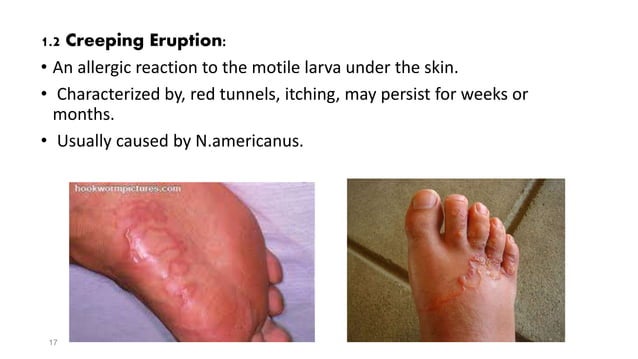 Hookworms Pptx Digestive Disorders Diseases And Conditions