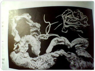 HOOK WORMS AND ASCARIASIS, medical Surgical Nursing course | PPTX