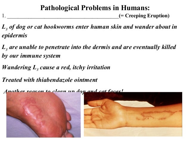 Hookworm infection