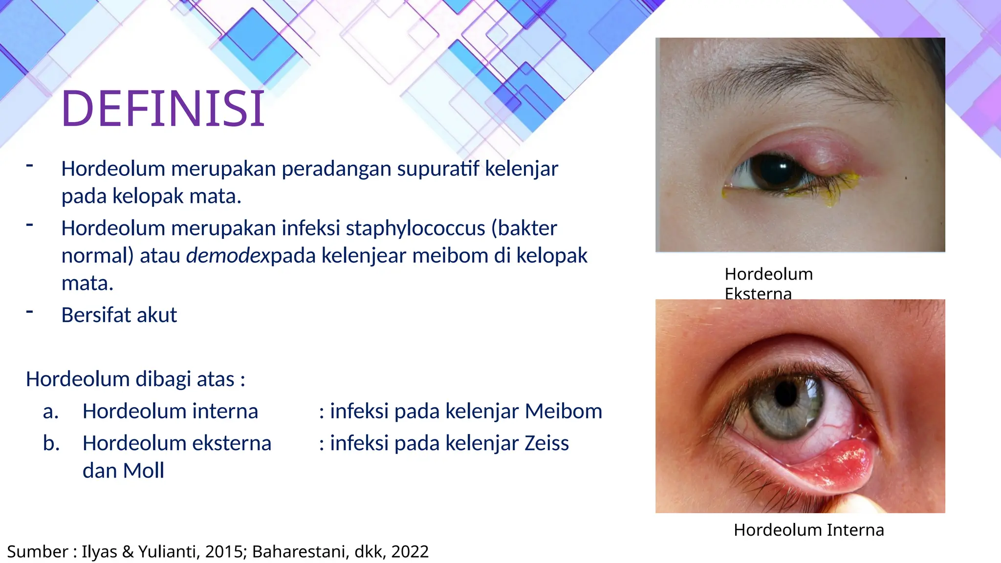 HORDEOLUM DAN KALAZION Tumor palpebra ppt.pptx